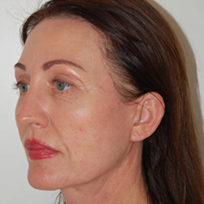 Upper Face Lift - Facelift München